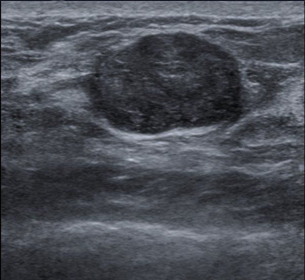 20 Benign Conditions Of The Breast SimpleMed Learning Medicine 20 Benign Conditions Of The Breast SimpleMed Learning Medicine